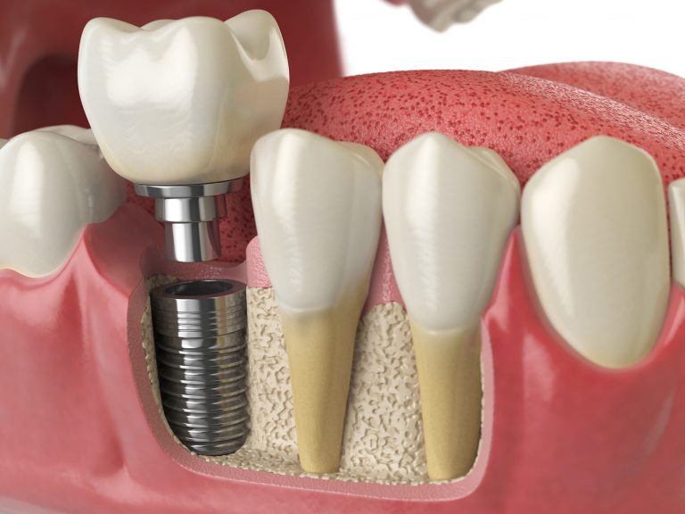 Dental Implants in New York | Implant Dentist & Dentistry NYC